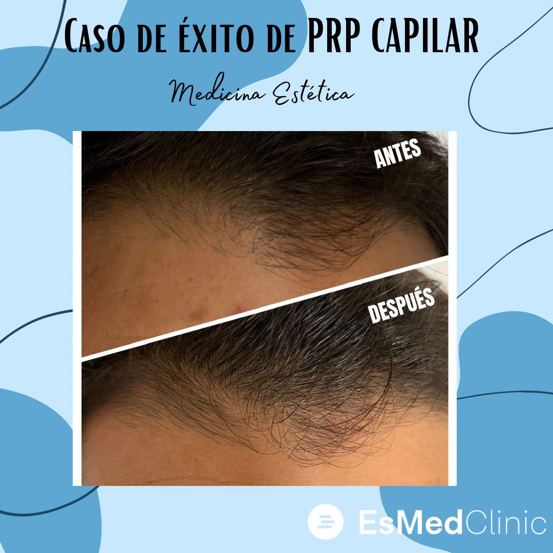 EsMed Clinic - Caso de éxito PRP Capilar